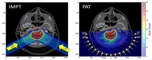 The Evolution of Radiotherapy That Led Us to Arc Therapy - Leo Cancer ...